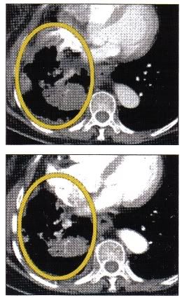 glejak.pl - złośliwy nowotwór mózgu, objawy i leczenie • Zobacz wątek ...